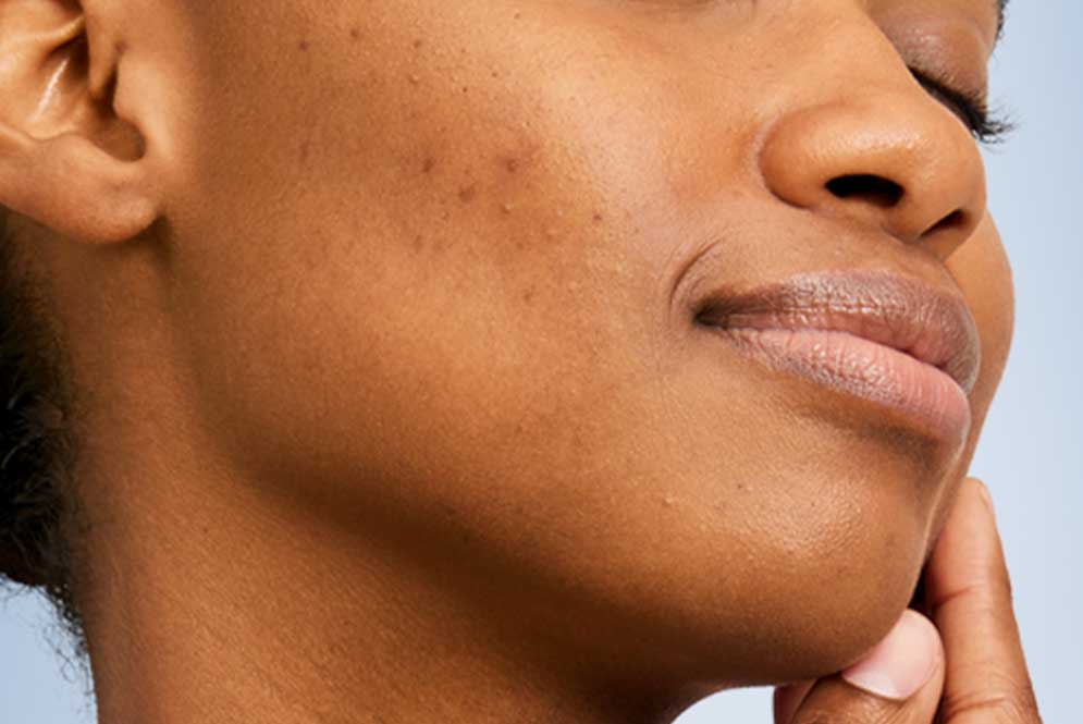 Penjelasan Lengkap Dermatitis Kontak Iritan dan Perbedaannya dengan Alergi